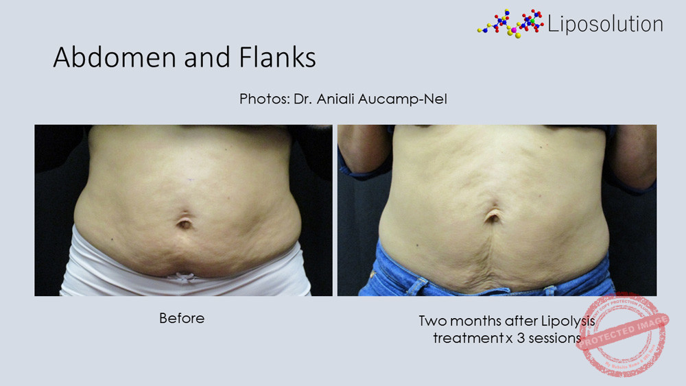 Before and after gallery - Liposolution