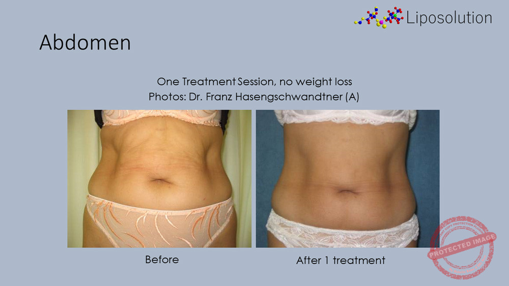 Before and after gallery - Liposolution