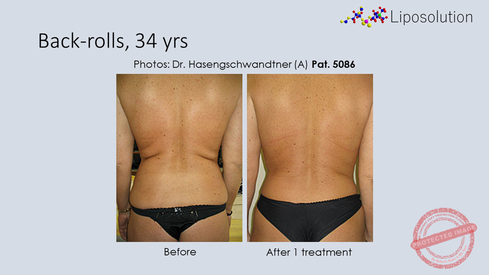 Before and after gallery - Liposolution