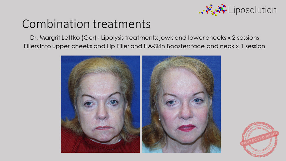Before and after gallery - Liposolution