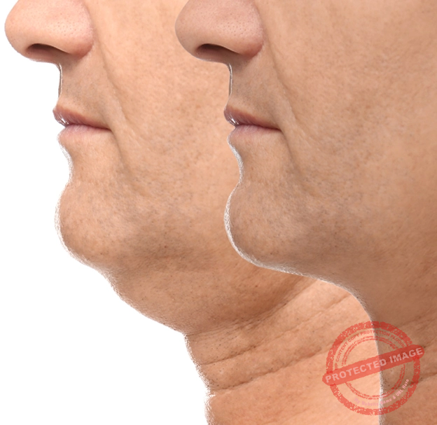 Treatment Information - Liposolution