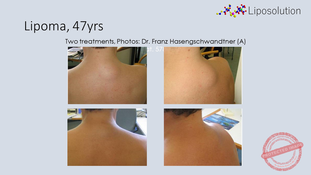 Before and after gallery - Liposolution