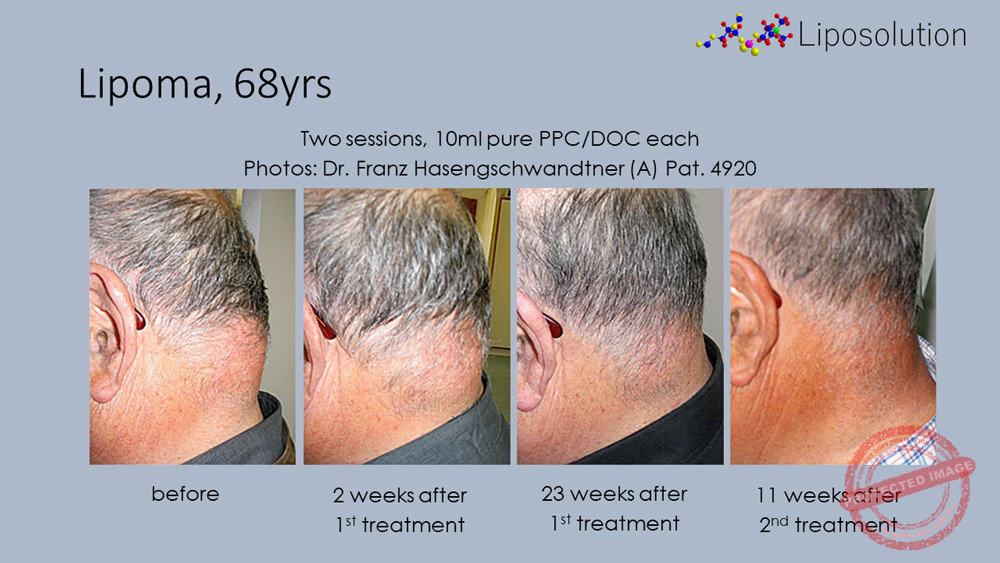 Before and after gallery - Liposolution